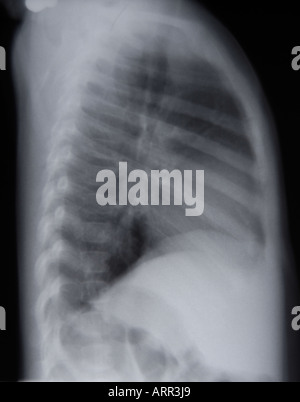 lateral view of normal pediatric chest x-ray Stock Photo - Alamy