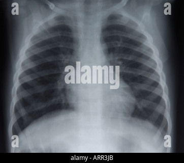 frontal view of normal pediatric chest x-ray Stock Photo - Alamy