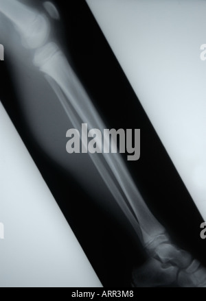 normal lateral x-ray of juvenile knee Stock Photo - Alamy