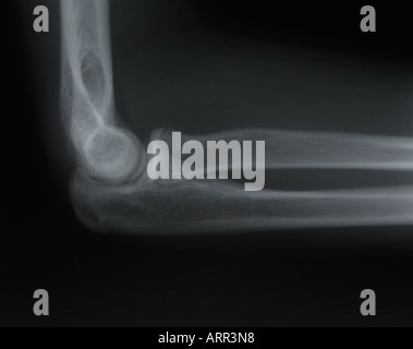 normal oblique x-ray of juvenile elbow Stock Photo - Alamy
