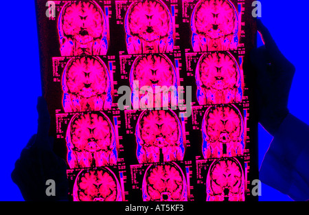 medical technician examining x-rays of cerebral cortex cerebellum human ...