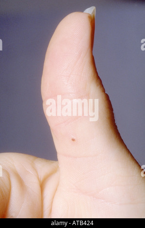 A photograph of the hand of a rheumatoid arthritis sufferer, prior to ...