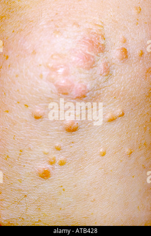 Tendon Xanthoma Hypercholesterolaemia Stock Photo Royalty