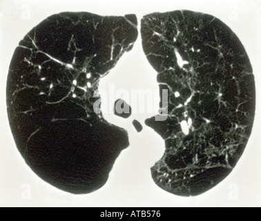 Emphysema. Computed tomography (CT) scan of an axial section through ...