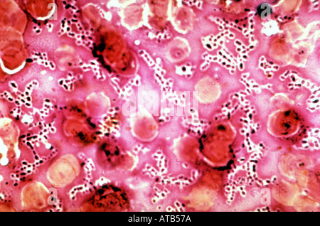 PNEUMOCOCCUS Stock Photo: 53847298 - Alamy