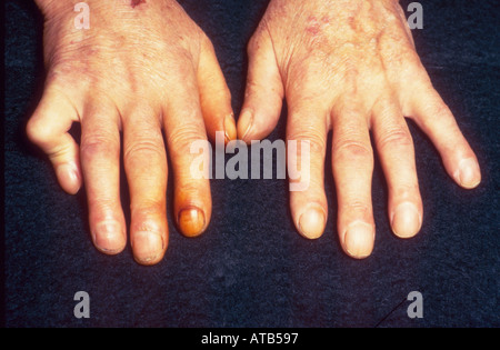 Finger clubbing secondary to lung cancer Stock Photo - Alamy