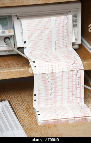 ECG / EKG graph / plot / chart / trace showing Atrial Fibrillation (AF ...