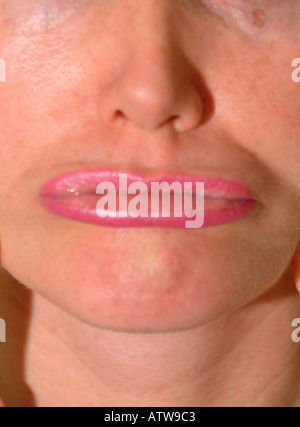 botox fat lips Stock Photo - Alamy