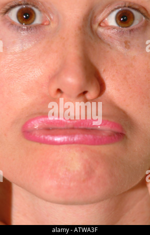 botox fat lips Stock Photo - Alamy