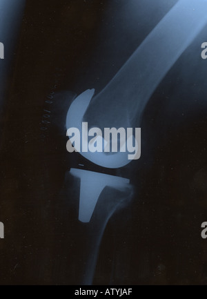 Knie TEP Prothese Gelenk kuenstliches Kniegelenk Roentgenbild Stock ...