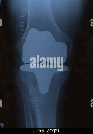 Knie TEP Prothese Gelenk kuenstliches Kniegelenk Roentgenbild Stock ...