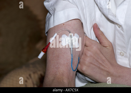 Picc line in arm of female cancer patient - peripherally inserted ...
