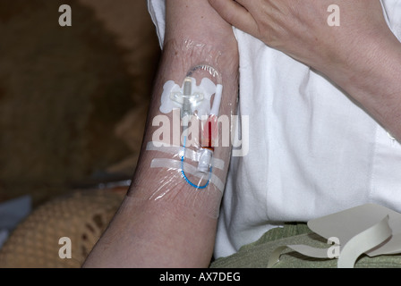 Picc line in arm of female cancer patient - peripherally inserted ...