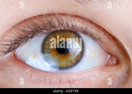Close-up of the white of the eye (sclera) of a 69 year old male patient ...