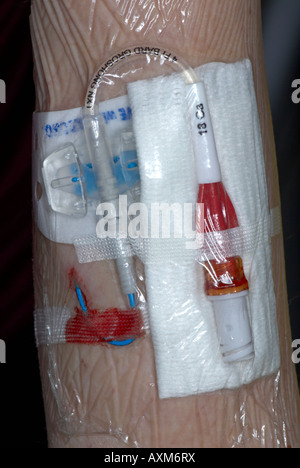 PICC line on the arm of a woman undergoing chemotherapy for breast ...