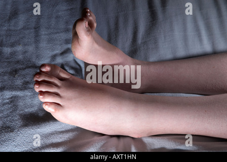 Swollen / puffy feet, toes and ankles of adult female woman after an ...