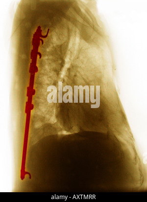 lumbar spine x-ray of a 33 yo female patient with scoliosis showing ...