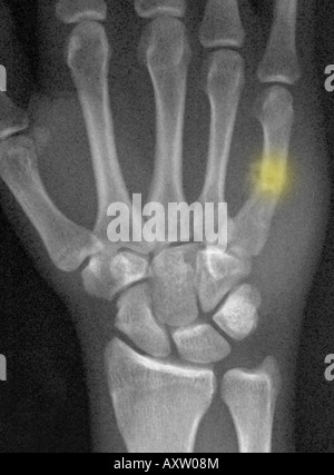 hand x-ray showing a healing boxer's fracture Stock Photo: 30441974 - Alamy