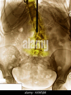 lumbar spine x-ray of a 33 yo female patient with scoliosis showing ...