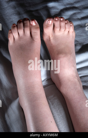 Swollen / puffy feet, toes and ankles of adult female woman after an ...