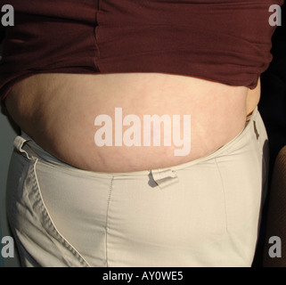 Obese woman with marks on body against white background. Weight loss ...
