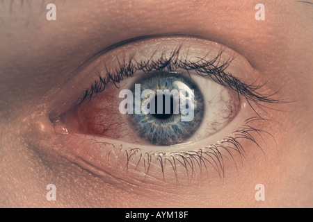 CHEMOSIS Stock Photo: 49156953 - Alamy