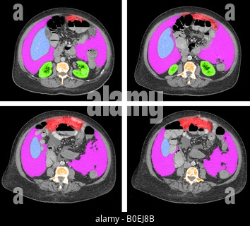 Ascites, CT scan Stock Photo - Alamy