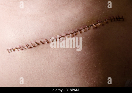 Operation stitches 7 Stock Photo - Alamy