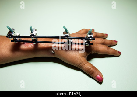 Senior woman with a broken fractured wrist with multiple breaks wearing ...