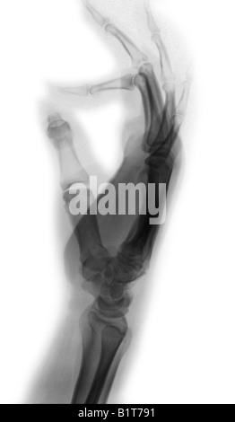 normal x-ray of the hand, lateral view Stock Photo - Alamy