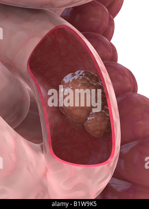 POLYP IN THE COLON, ANATOMY Stock Photo - Alamy