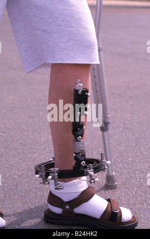 WOMAN'S LEG WITH EXTERNAL FIXATOR Stock Photo - Alamy
