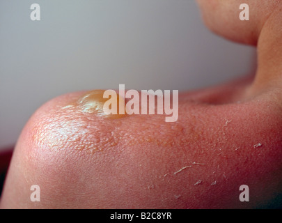 Close up of a severe sunburn blister on a childs shoulder Stock Photo ...
