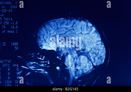 Horizontal section of a human brain - MRI scan Stock Photo - Alamy