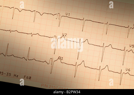 Heart disease. Electrocardiogram (ECG) of the heartbeat of an 18-year ...