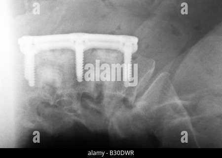 X ray of human lumber spine showing hardware used in an Anterior lumbar ...