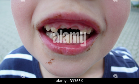 Child With Gaps Between The Teeth Gap Between The Teeth Gap Between