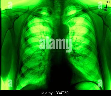 colored coded chest x-ray Stock Photo - Alamy