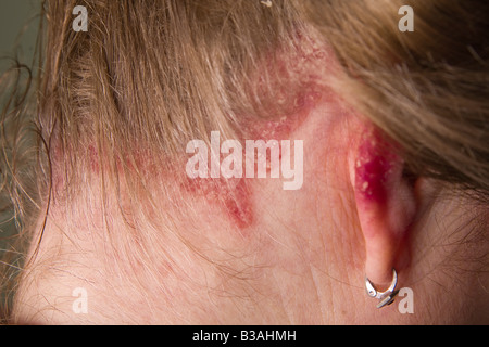 Psoriasis on ear and scalp in a woman of 60 years old Stock Photo - Alamy