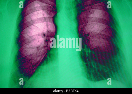 colored coded chest x-ray male Stock Photo - Alamy