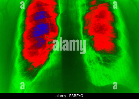 colored coded chest x-ray Stock Photo - Alamy