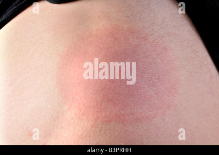 Skin rash, Erythema migrans, following a tick bite Stock Photo - Alamy