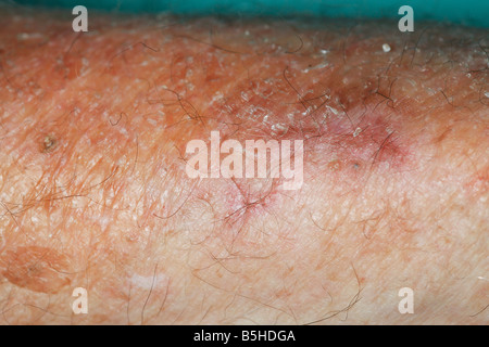 skin thinning on a elderly man's arm Stock Photo - Alamy