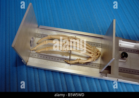 Bone length measuring device here with human hand bones used by ...