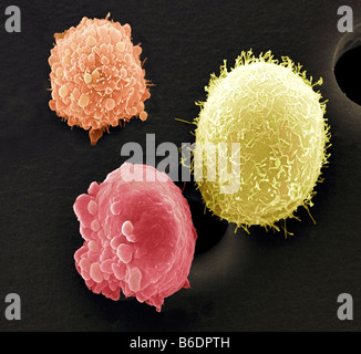 Skin cancer cell, coloured scanning electron micrograph (SEM). Cultured ...
