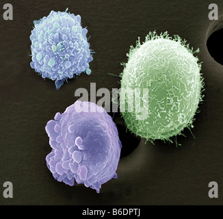 Skin cancer cell, coloured scanning electron micrograph (SEM). Cultured ...
