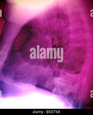 Coloured chest X-ray of the lung of a patient with valley fever, or ...