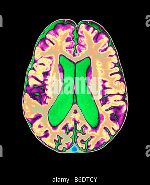 Organophosphate brain damage. Coloured magnetic resonance imaging (MRI) scan of a man's brain ...