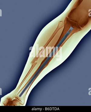 Pinned broken leg coloured X-ray. The patient's femur (thigh bone) has ...