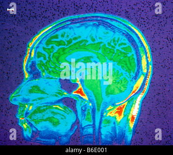 Normal human brain, Coloured magnetic resonance imaging (MRI) scan of a ...